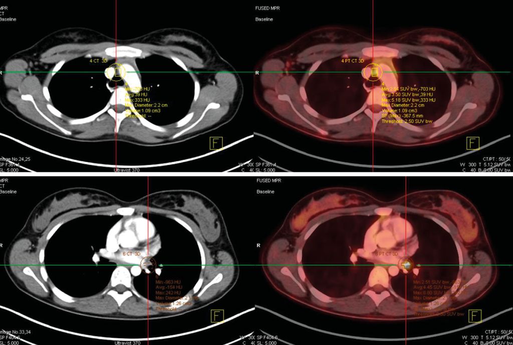 Sarkoidose: die Fortschritte der letzten 20 Jahre - Pneumologie - Universimed - Medizin im Fokus